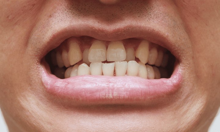 6 Types of Crossbite Conditions – Diamond Braces