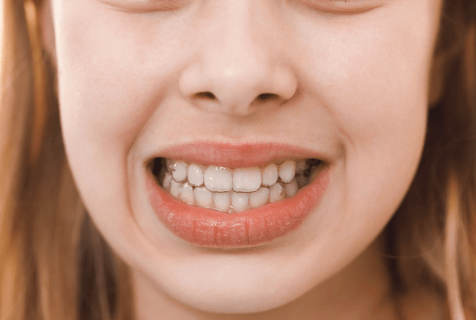 Braces Wire Poking Your Cheeks or Gums? Here’s What to Do – Diamond Braces