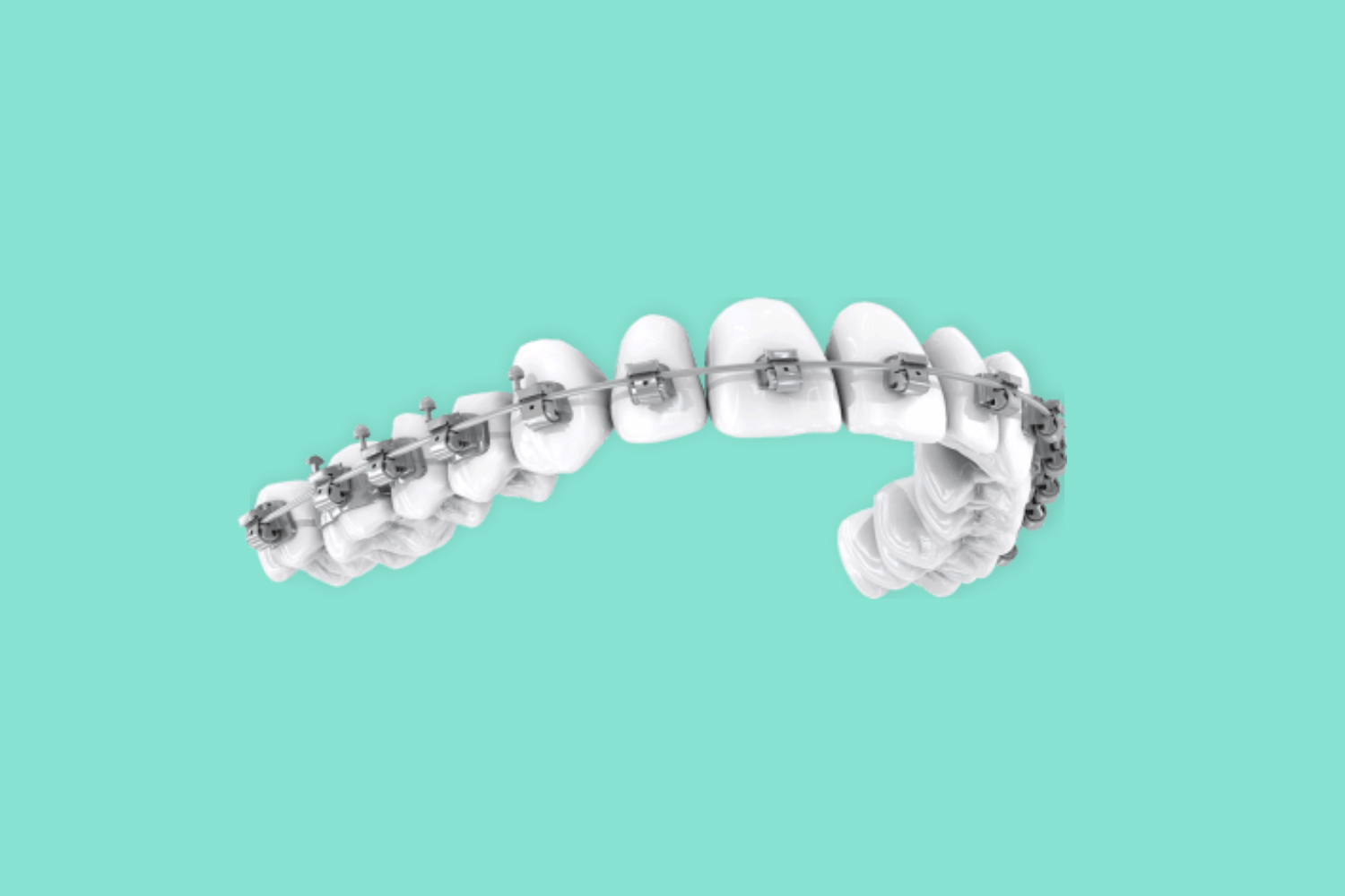 How Much Do Braces Cost with Dental Financing – Diamond Braces