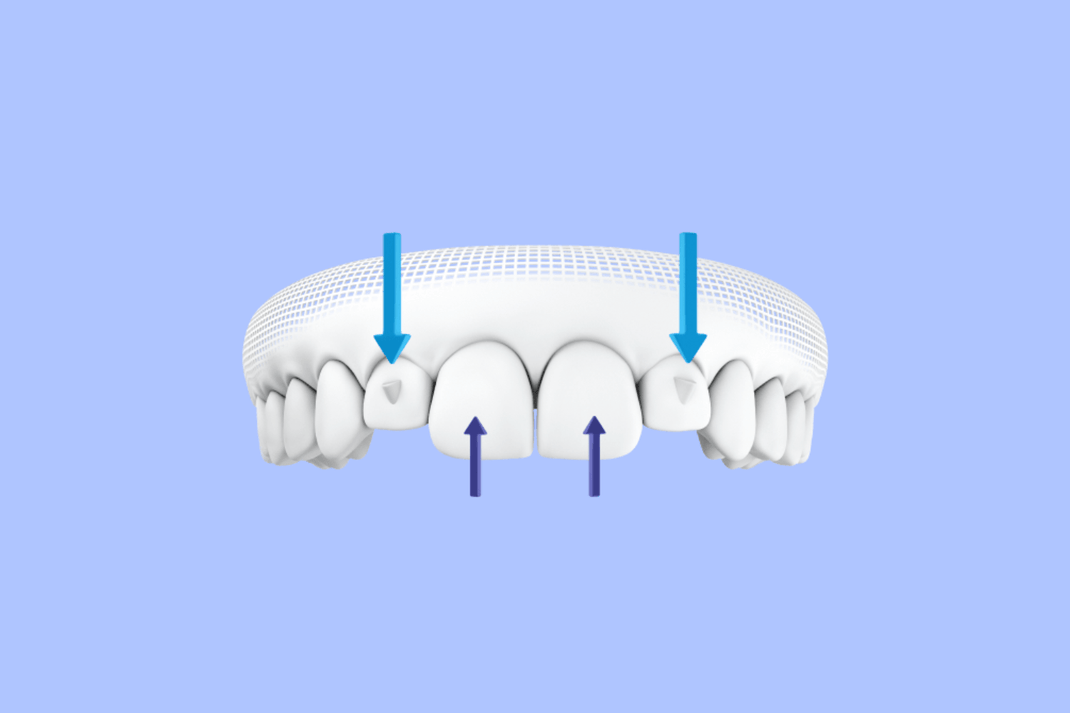Invisalign Attachments: How They Work, Benefits, and Care – Diamond Braces