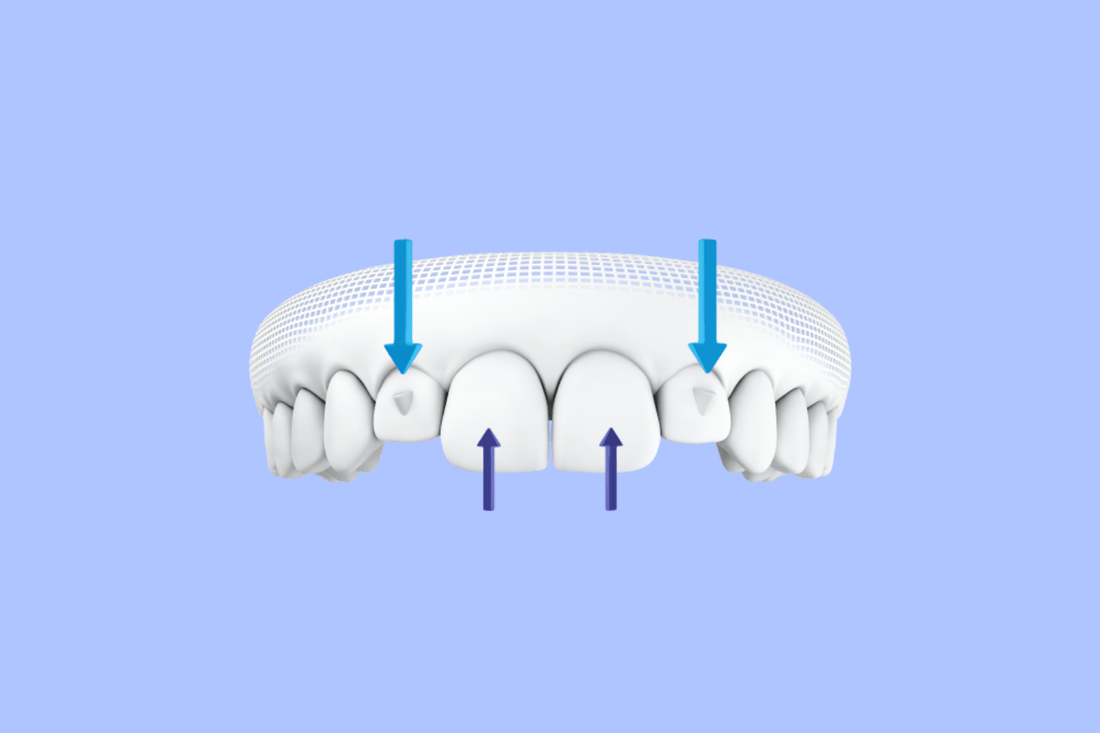 Invisalign Attachments: How They Work, Benefits, and Care – Diamond Braces