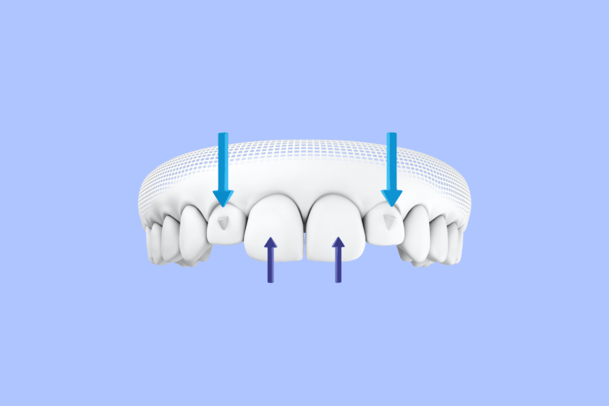 Invisalign Attachments: How They Work, Benefits, and Care – Diamond Braces