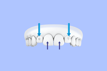 Invisalign Attachments: How They Work, Benefits, and Care – Diamond Braces