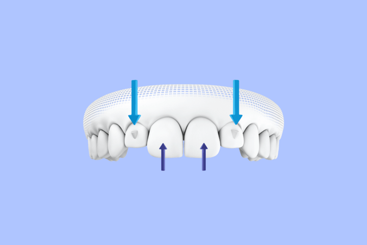 Invisalign Attachments: How They Work, Benefits, and Care – Diamond Braces