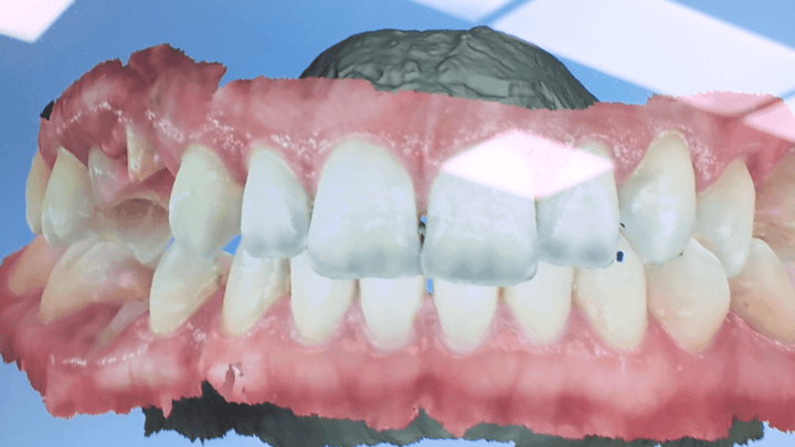 Vivera Removable Retainers | Diamond Braces