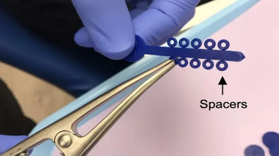 Seperators for Braces: Their Use, If They Hurt, and Care – Diamond Braces