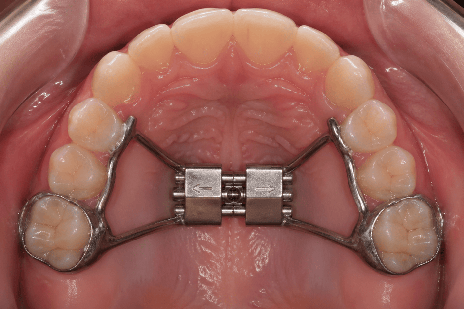 What Is a Palate Expander and What Is It Used For? – Diamond Braces