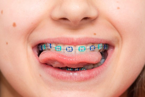 Orthodontic Emergency - Braces – Diamond Braces
