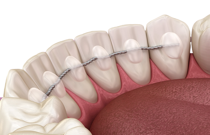 Braces and Invisalign Pricing | Diamond Braces