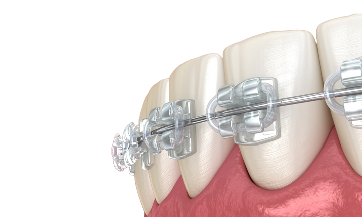Braces and Invisalign Pricing | Diamond Braces