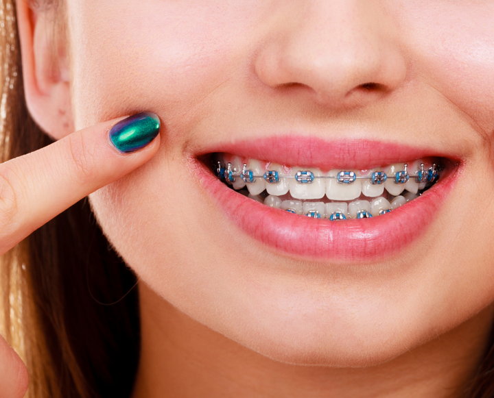 Braces for Kids & Adults | Diamond Braces