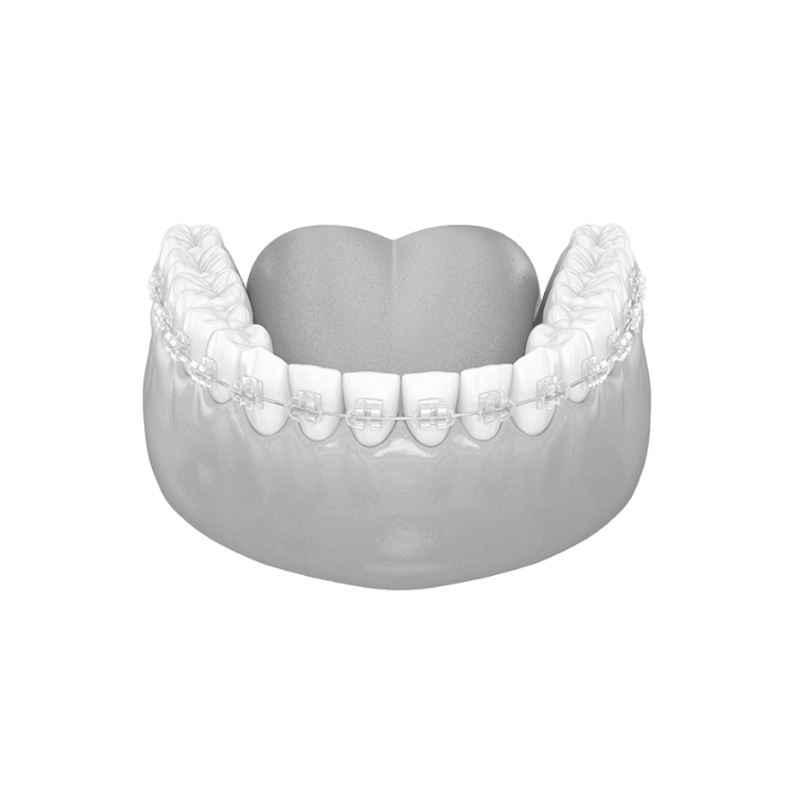 Ceramic & Invisible Braces | Diamond Braces